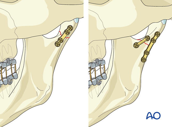 ORIF, plate fixation with two plates for Condylar process and head ...