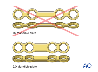 Plate fixation with one plate for Condylar process and head - simple ...