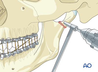 ORIF, plate fixation with two plates for Condylar process and head ...