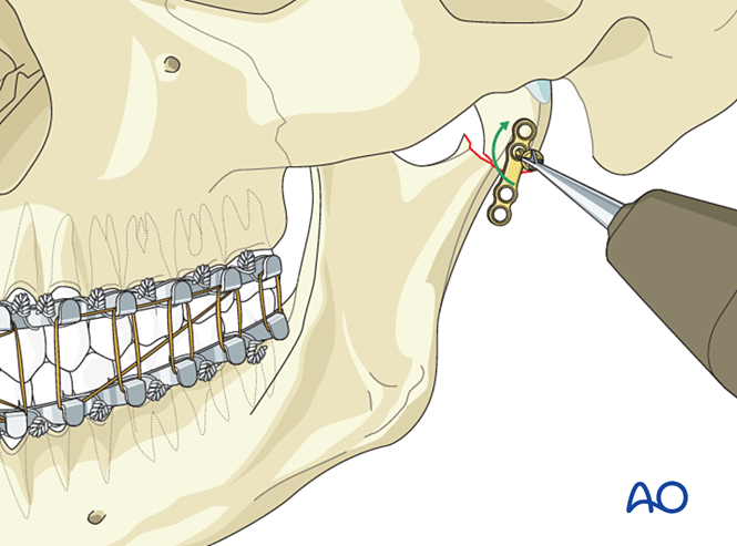 Plate fixation with one plate for Condylar process and head - simple ...