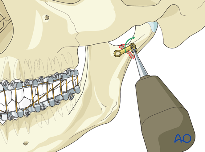 ORIF, plate fixation with two plates for Condylar process and head ...