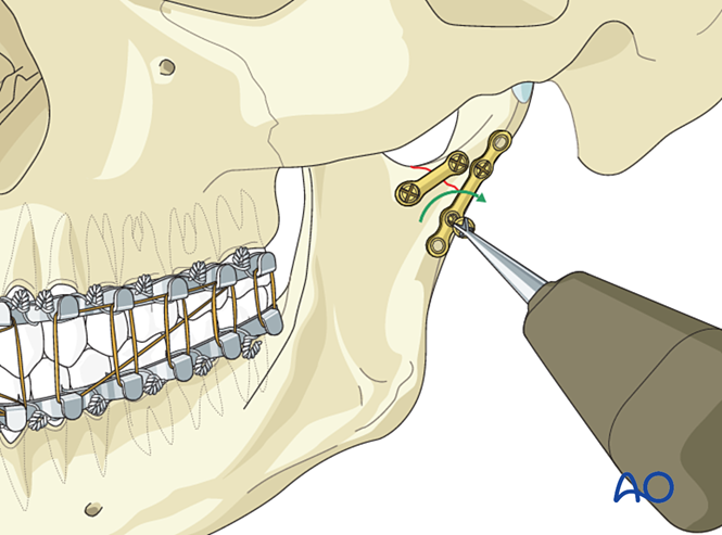 ORIF, plate fixation with two plates for Condylar process and head ...
