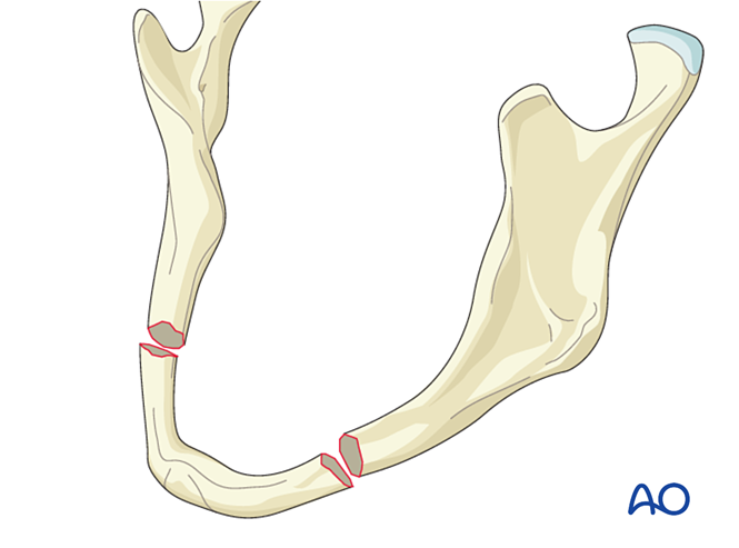 Fractures in the edentulous atrophic mandible