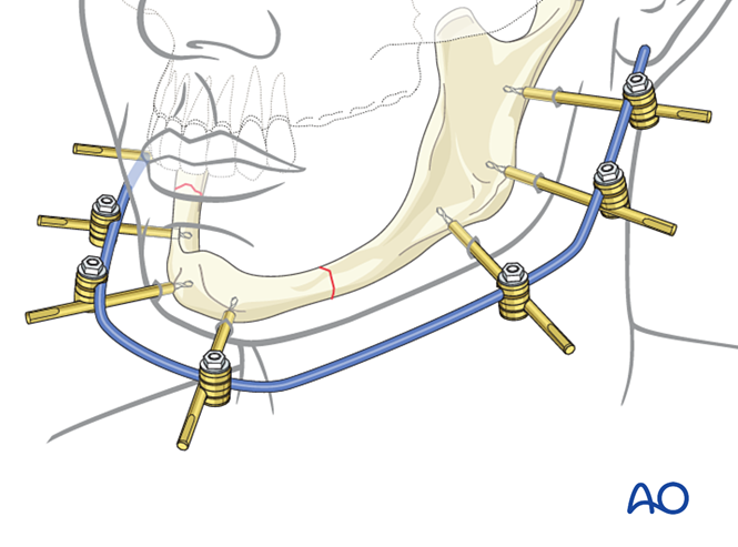 Fractures in the edentulous atrophic mandible