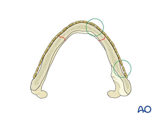 Fractures in the edentulous atrophic mandible