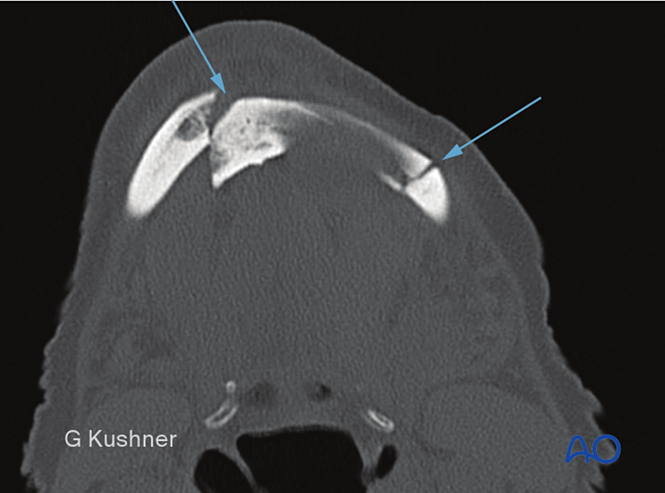 Fractures in the edentulous atrophic mandible