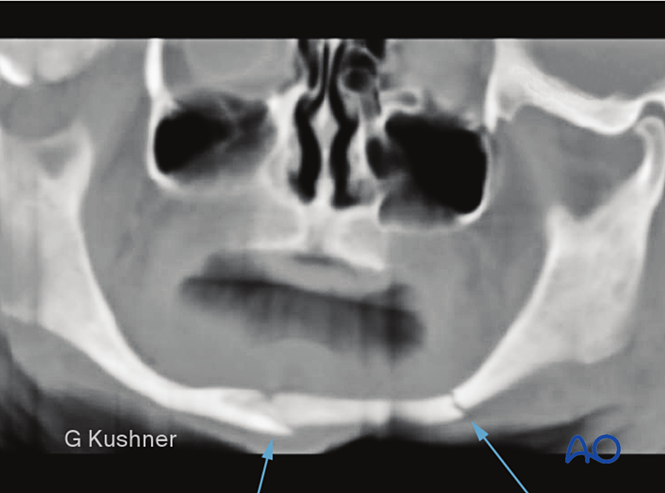 Fractures in the edentulous atrophic mandible