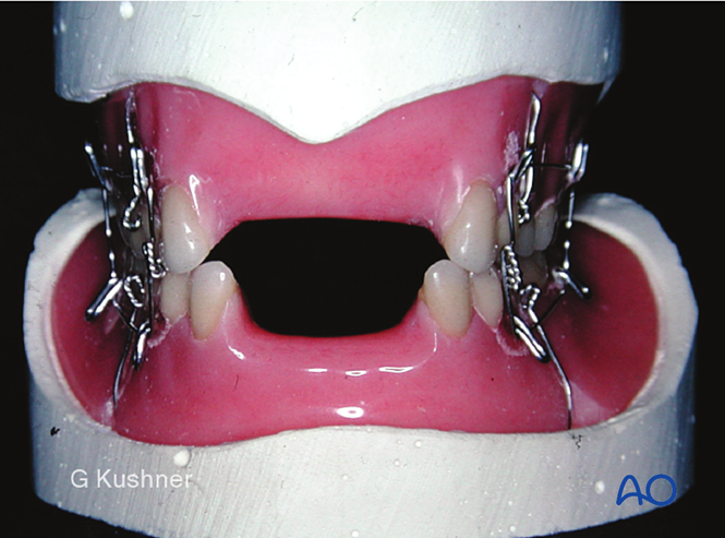 Fractures in the edentulous atrophic mandible