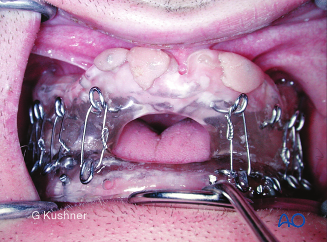 Fractures in the edentulous atrophic mandible