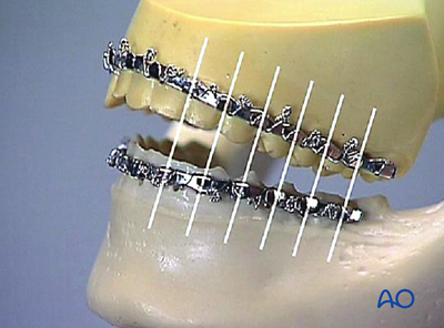 90 X010 maxillomandibular fixation