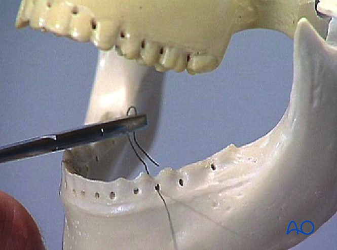 Maxillomandibular fixation (MMF)