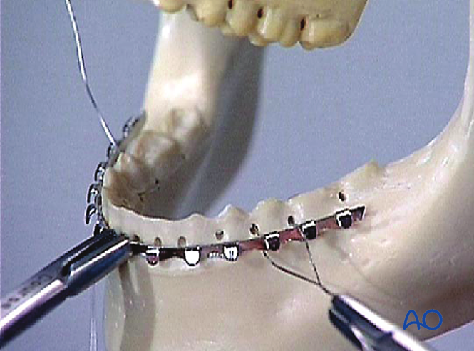 90 X010 maxillomandibular fixation