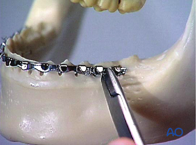 90 X010 maxillomandibular fixation