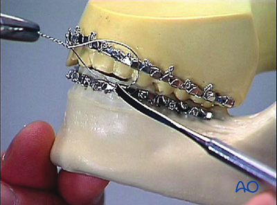 90 X010 maxillomandibular fixation