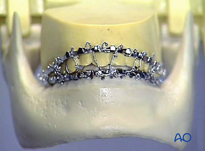 Maxillomandibular fixation (MMF)