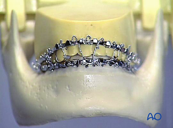 Maxillomandibular fixation (MMF)
