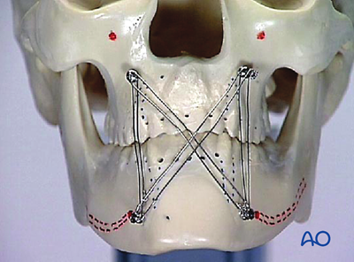 Maxillomandibular fixation (MMF) - Bone supported devices