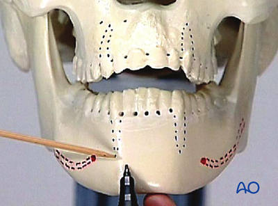Maxillomandibular fixation (MMF) - Bone supported devices