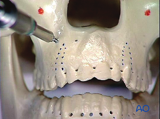 Maxillomandibular fixation (MMF) - Bone supported devices