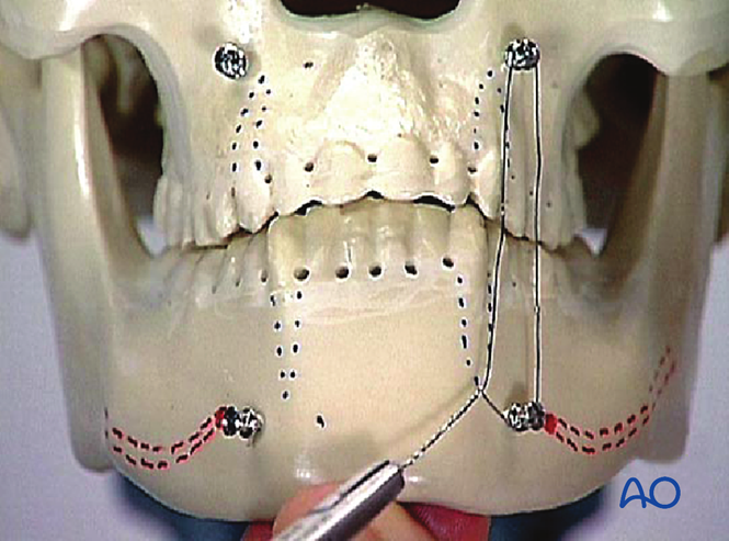 Maxillomandibular fixation (MMF) - Bone supported devices