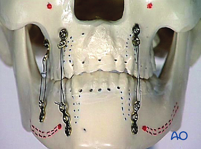 Maxillomandibular fixation (MMF) - Bone supported devices