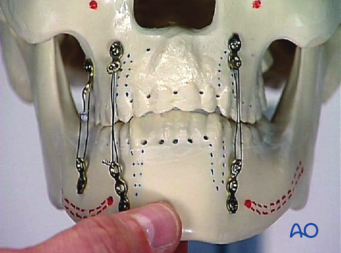 Maxillomandibular fixation (MMF) - Bone supported devices