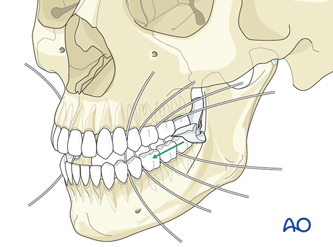 Interdental wires (embrasure)