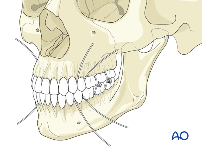 Interdental wires (embrasure)