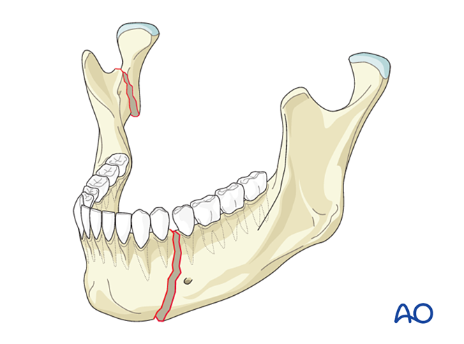 Multiple fractures