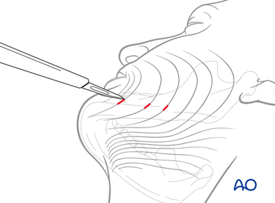 90 X020 transbuccal system new