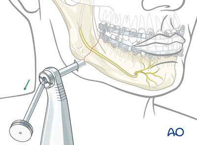 90 X020 transbuccal system new