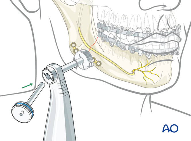 90 X020 transbuccal system new