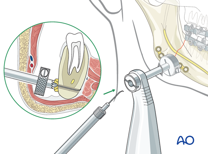 90 X020 transbuccal system new