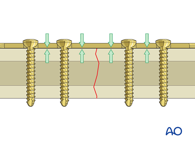 90 X040 Locking plate principles NEW
