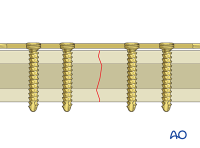 Locking plate principles