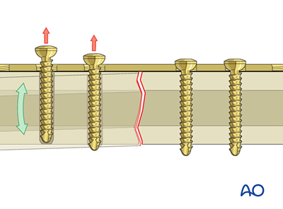 90 X040 Locking plate principles NEW