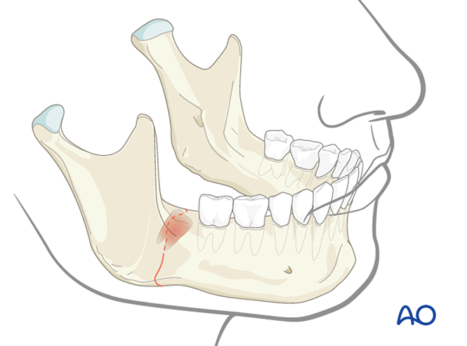 Teeth in the line of fracture