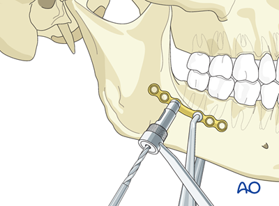 Screw insertion into locking plates