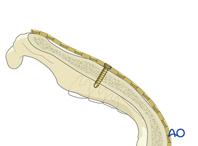 Screw insertion into locking plates