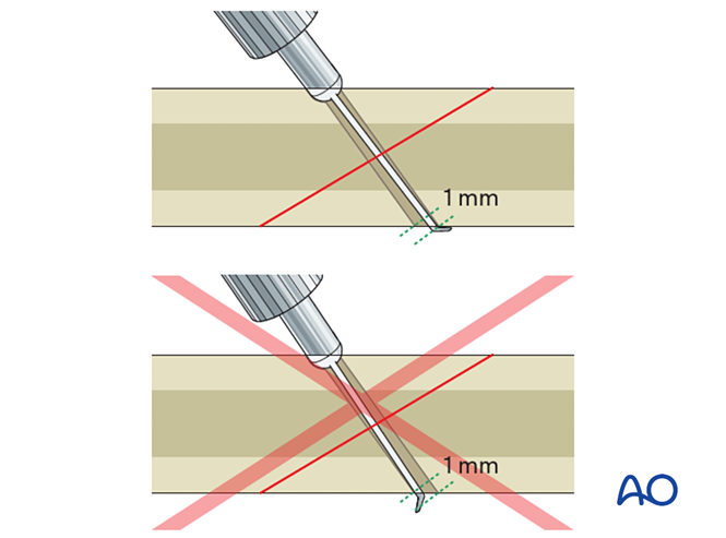 Lag screw technique
