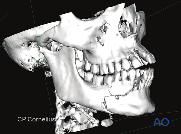 Alveolar Bone Fracture Ppt