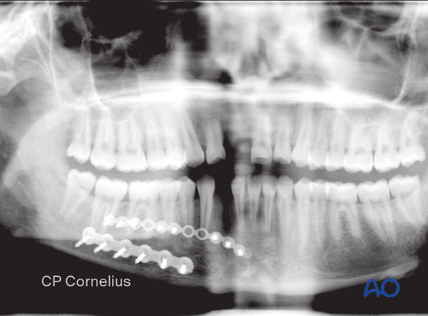 Alveolar Bone Fracture Ppt