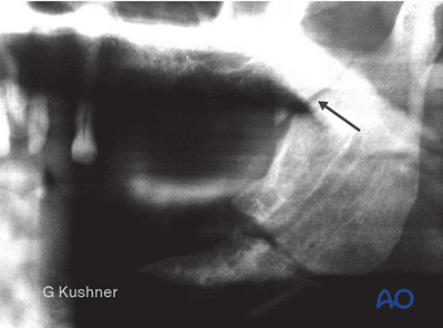 Coronoid process fractures