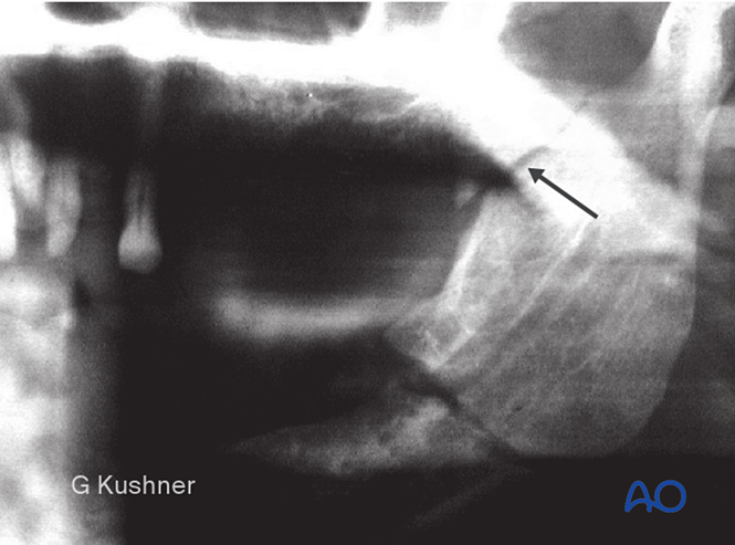 Coronoid process fractures