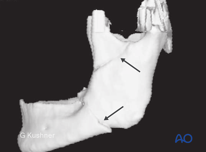 Coronoid process fractures