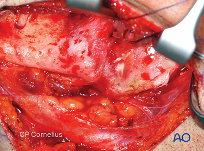 Infected fracture with or without bone loss