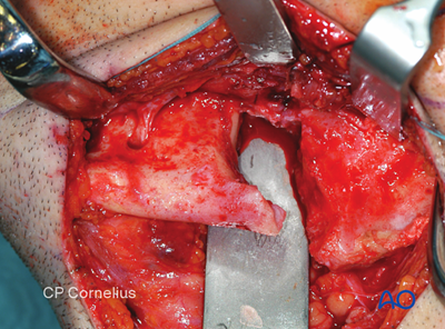Infected fracture with or without bone loss
