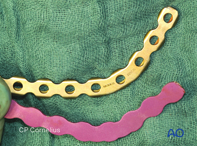 Infected fracture with or without bone loss