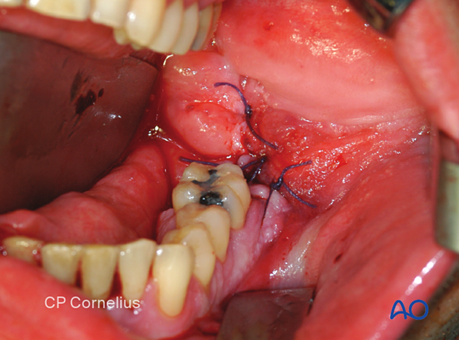 Infected fracture with or without bone loss