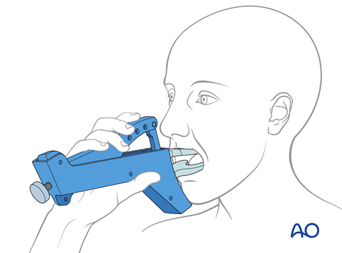 ORIF, arch bar and load-sharing plate for Symphysis and parasymphysis ...
